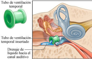 Drenaje De Los Oídos En Niños - Audiotechno - Tus centros auditivos